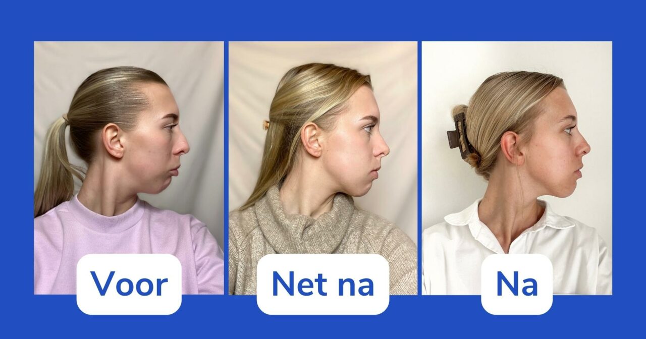 Sanne vertelt over haar ervaring met een kaakoperatie